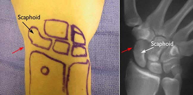 Scaphoid Fracture Of The Wrist OrthoInfo AAOS